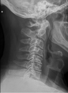 Corregir la rectificación cervical ¿es posible? - www.medspine.es